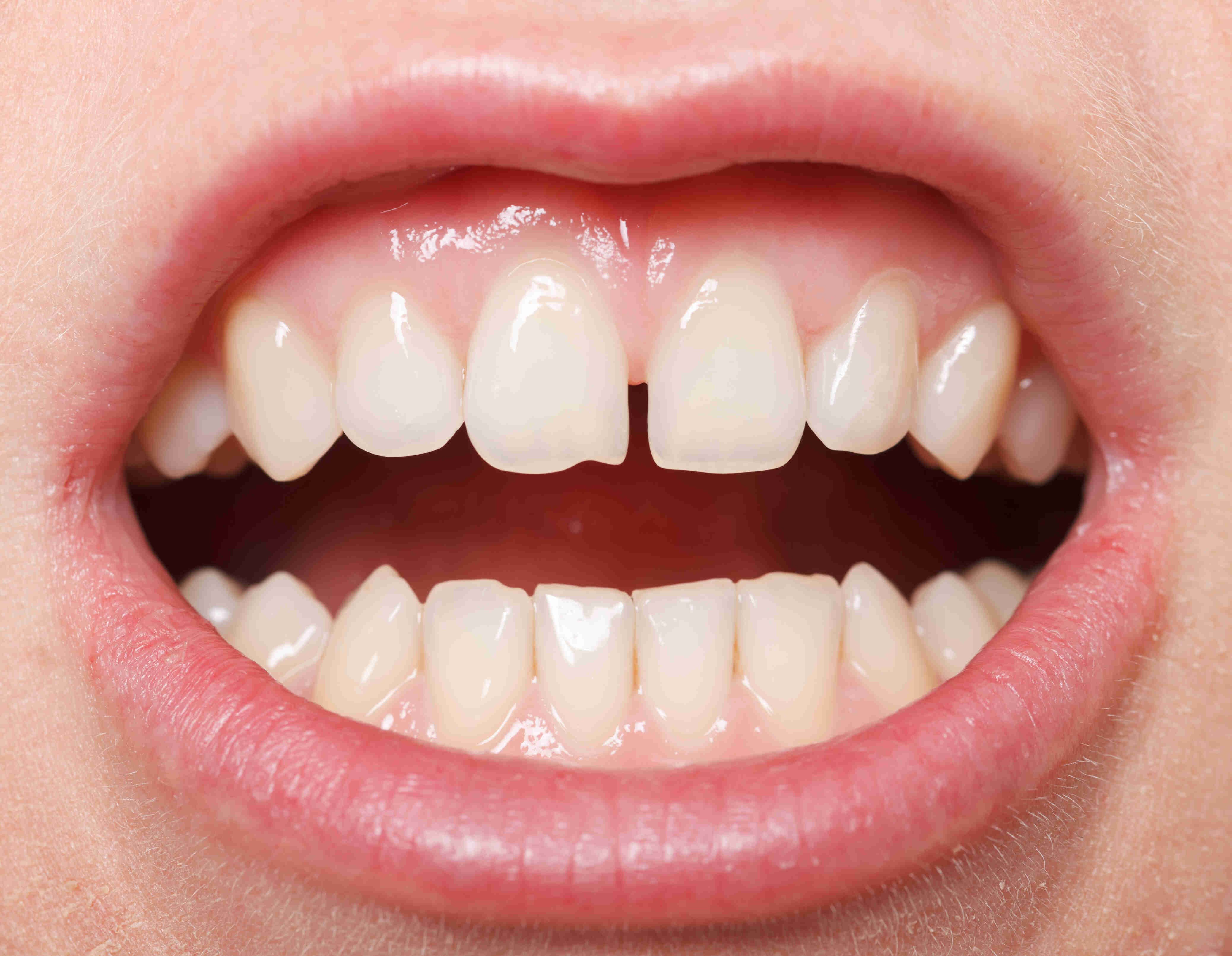 Veneers: Improving Your Teeth's Apperance | Nuffield Dental