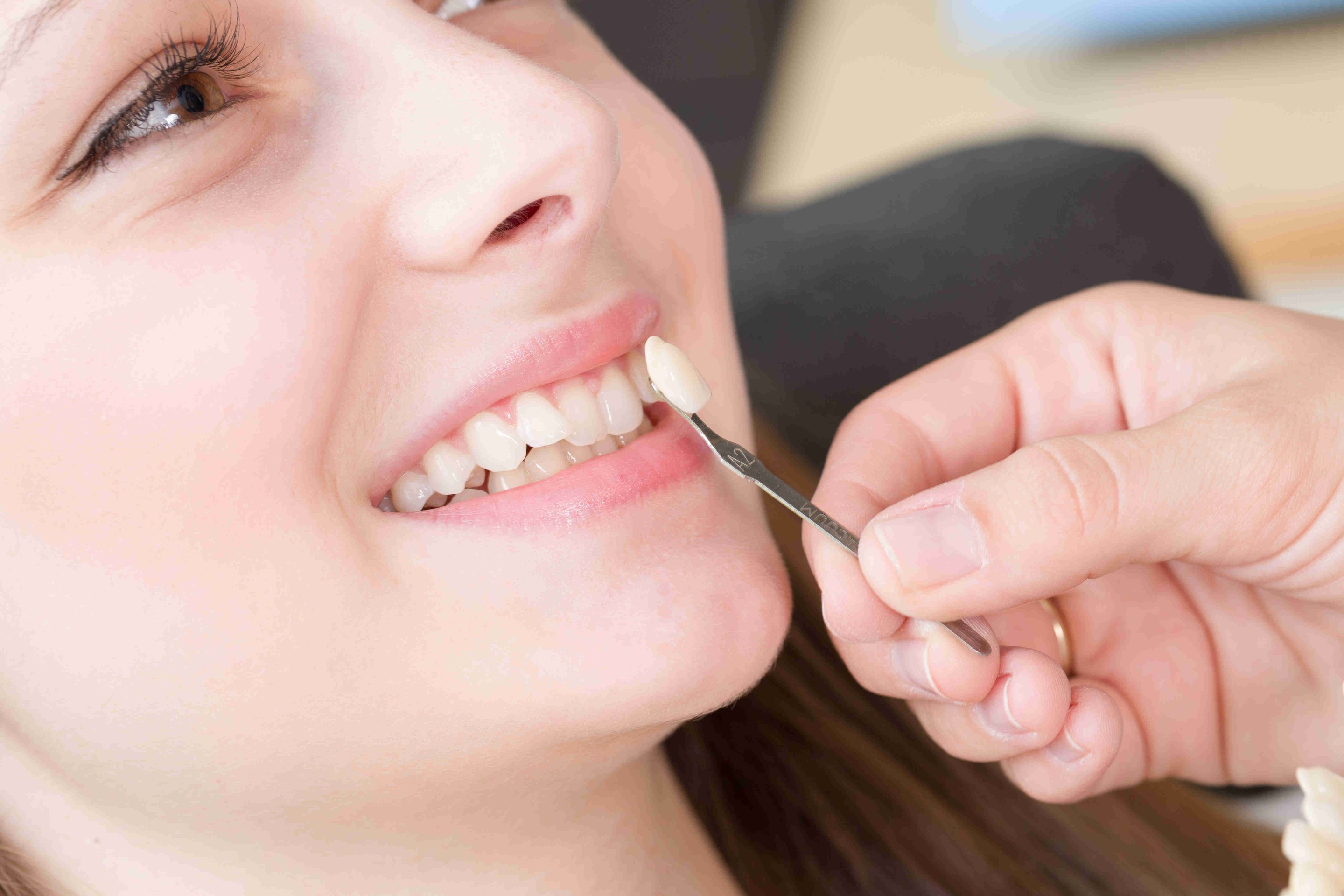 Veneers: Improving Your Teeth's Apperance | Nuffield Dental