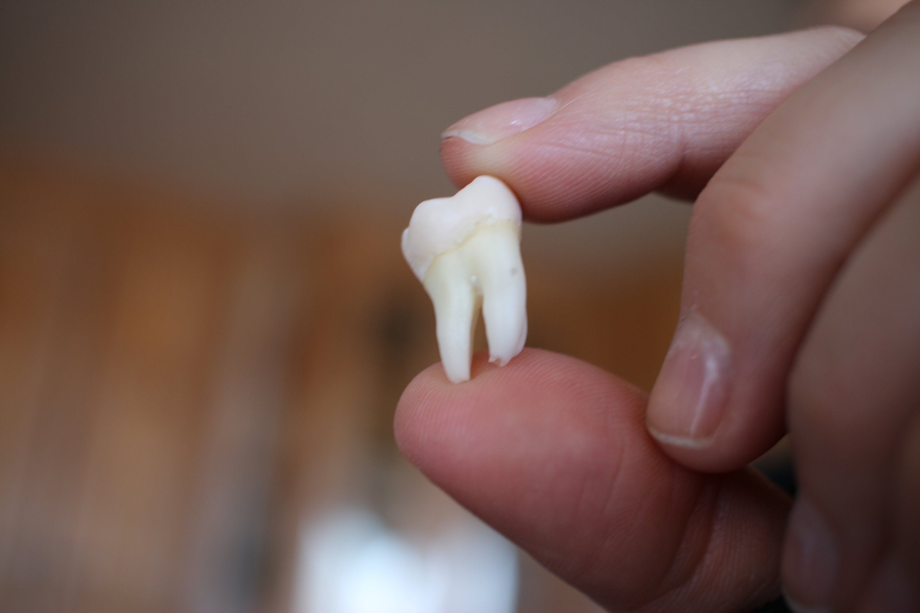 Impacted Wisdom Tooth: Causes, Relief and Remedies