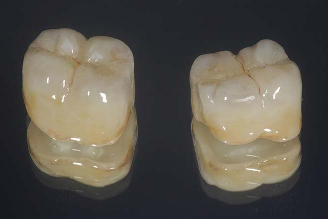 Dental Crowns: Restoring Your Tooth | Nuffield Dental