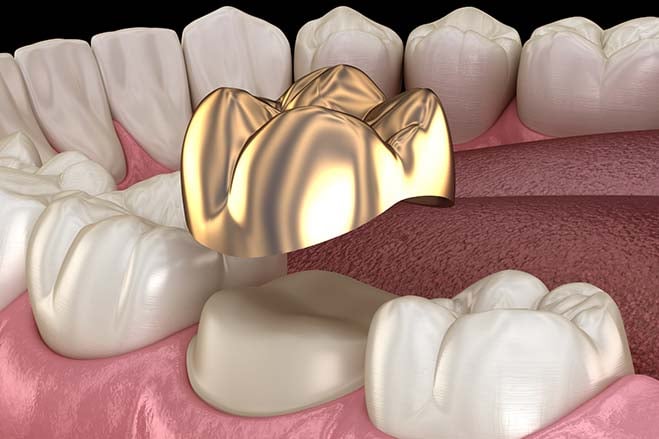 Dental Crowns: Restoring Your Tooth | Nuffield Dental