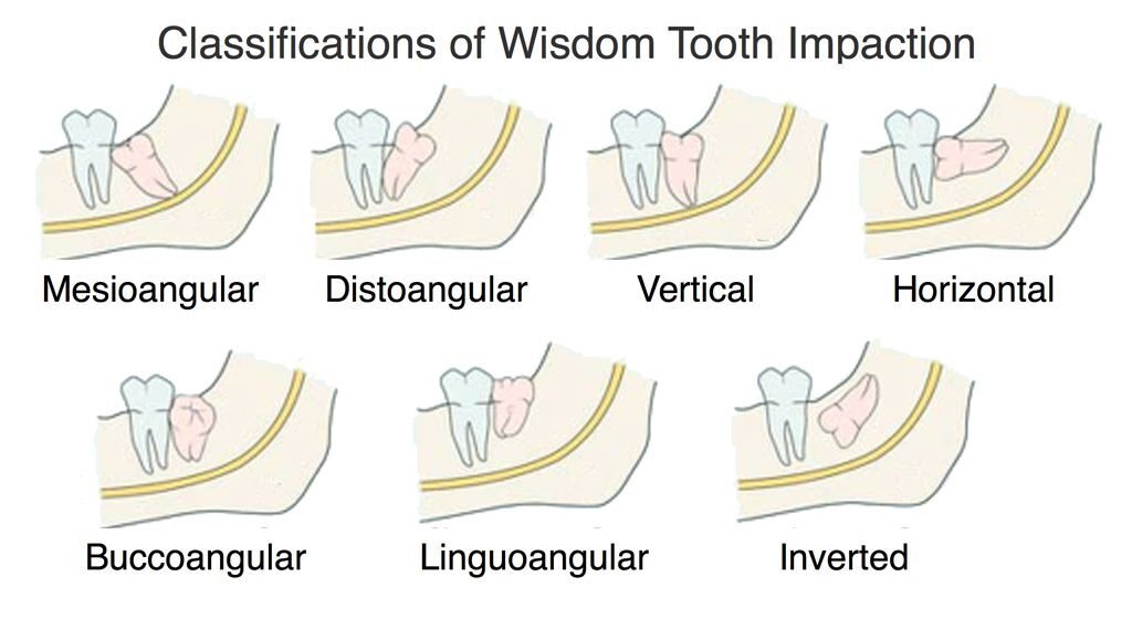 Impacted Wisdom Tooth: Causes, Relief and Remedies