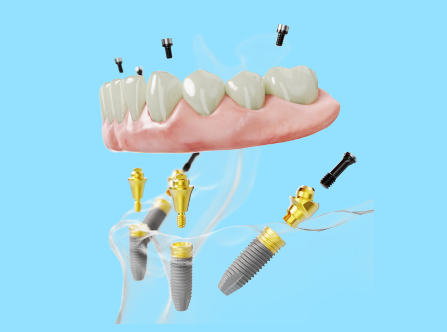 What is an All-on-4 Procedure?